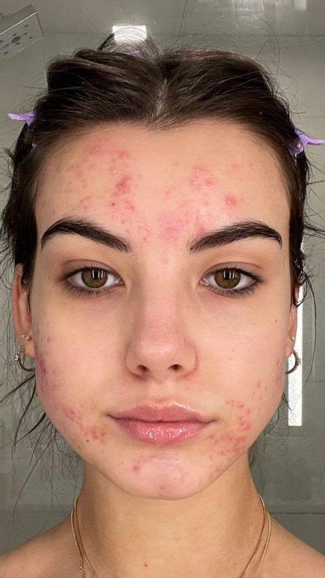 Beautiful Girls With Acne