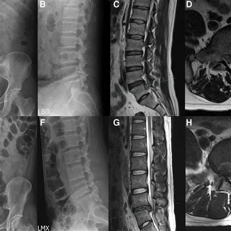 Two Patients With Lumbosacral Transitional Vertebrae A D A Download Scientific Diagram