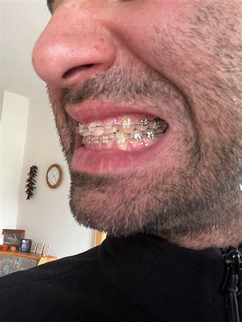 First Day And After 2 Years Rbraces