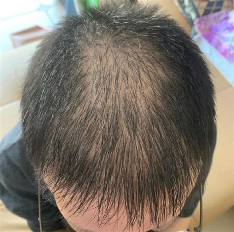 【男士防脱发】脱发问题严重怎么解决啊？医学硕士教你3步解决男士脱发问题，2个月有效防脱发，不秃顶、不脱发、保住发际线，发量惊人！ 知乎