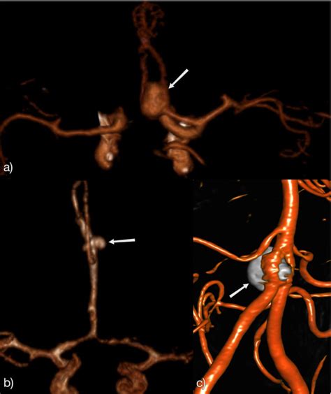Aneurysms Arrows Associated With Anomalies A Aplasia Of A1 With Download Scientific Diagram