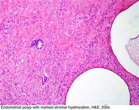 Pathology Outlines Endometrial Polyp