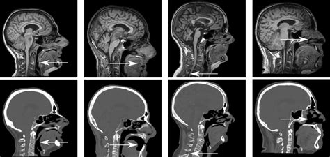 Examples Showing Local Misalignment Between Mr And Ct Images After Download Scientific Diagram