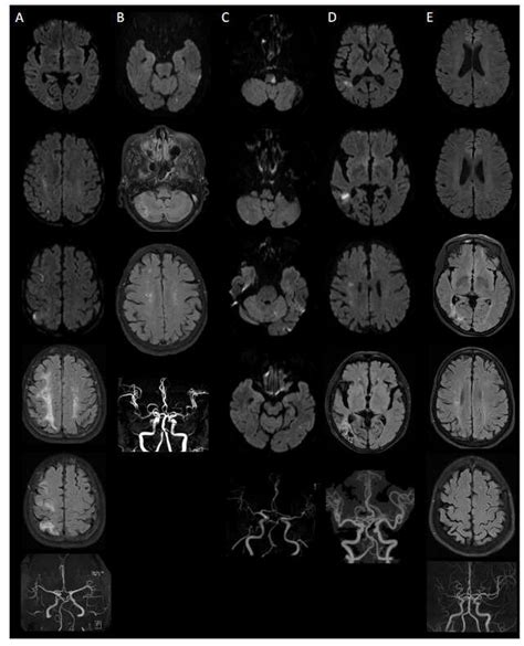 Mri Findings Of The Five Cases A Multiple Embolic Acute Infarctions Download Scientific