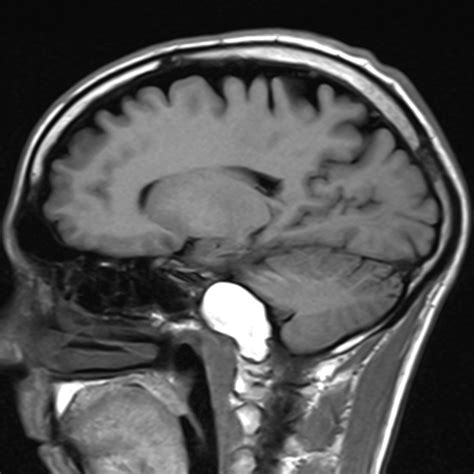 Cholesterol Granuloma Radiology At Nilsa Sutton Blog