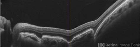 Focal Choroidal Excavation Fce What Is It
