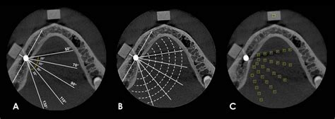 Does The Metal Artifact Reduction Algorithm Activation Mode Influence The Magnitude Of Artifacts