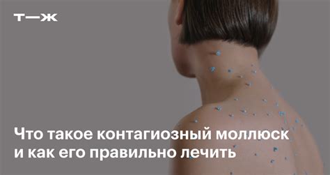 Контагиозный моллюск что это как выглядит и передается симптомы лечение