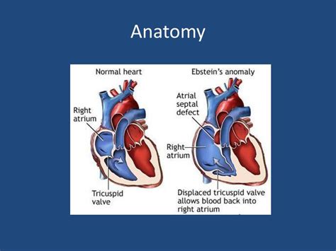 Ppt Ebsteins Anomaly Powerpoint Presentation Free Download Id4585458