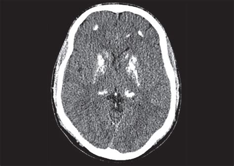 Focal Calcification In Brain Mapasgmaes
