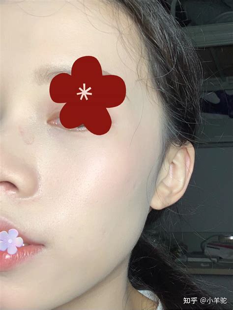 陈年痘印一两年的那种怎么去？？ 知乎