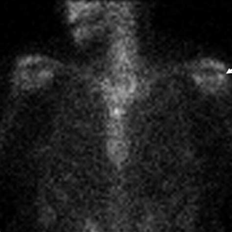 A 36 Year Old Female With Calcific Tendinopathy Of The Left Rotator