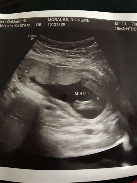 Second Trimester Ultrasound Pictures Artofit