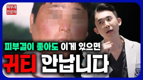 지긋지긋한 안면홍조 치료가 가능할까요 안면홍조 원인 관리 치료법 Youtube