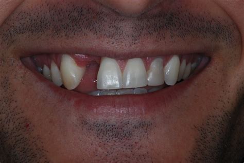 What S The Best Way To Replace A Missing Tooth Or Teeth Hubpages