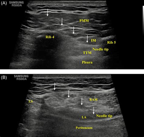 A Sono‐anatomy Of Transversus Thoracic Plane Block The Target For
