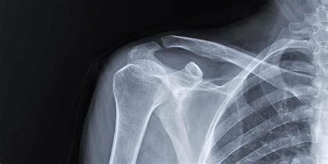 What To Wear For Shoulder X Ray At James Denton Blog