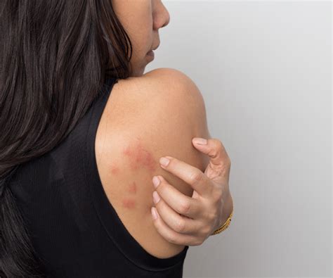 Urticarial Rash What Causes Urticaria And How To Identify It Dr