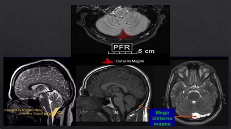 Cerebral Cisterns For Radiology Dnb Pptx