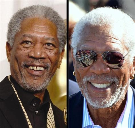 Celebrity Dental Implants Before And After Famous Teeth Implants