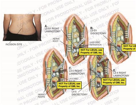 Lumbar Laminotomy And Discectomy 97250a24b Generic Medical Legal