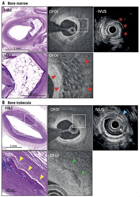 Intravascular Imaging And Histological Correlates Of Medial And Intimal Calcification In