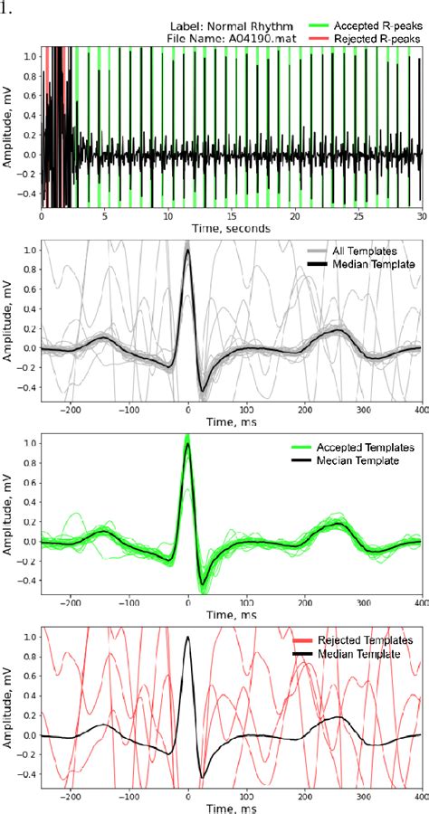 Figure 1 From Classification Of Atrial Fibrillation Using Multidisciplinary Features And