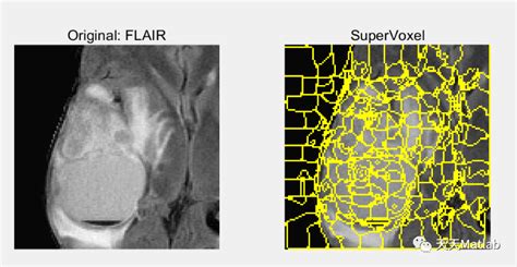 基于监督学习的多模态mri脑肿瘤分割算法研究，使用来自超体素的纹理特征，附代码基 于 多 态 M R I 影 像 的 脑 肿 瘤 分 割
