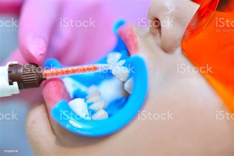 여자 치과 의사가 치아를 표백하기 전에 치아에 젤을 적용합니다 건강 진단에 대한 스톡 사진 및 기타 이미지 건강 진단 건강관리와 의술 레이저 Istock