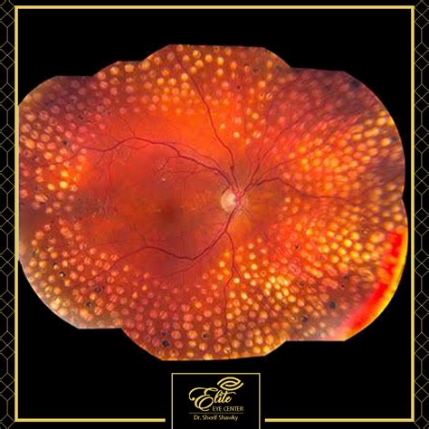 علاج الشبكية بالليزر
