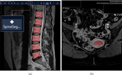 Krishna Swamy Jalla On Linkedin Fastmonai Surgeclasses Medicalimaging Deeplearning