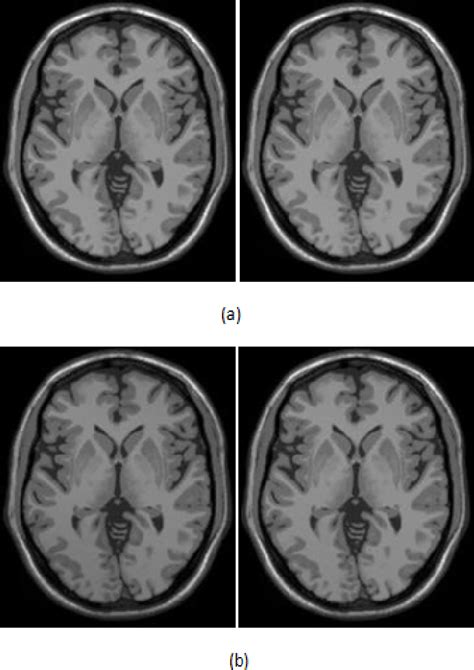 Intelligent Brain Mri
