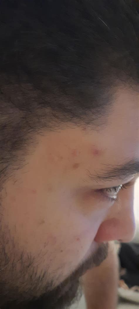 Can I Use Differin Gel And Skinoren At The Same Time R Acnetreatments