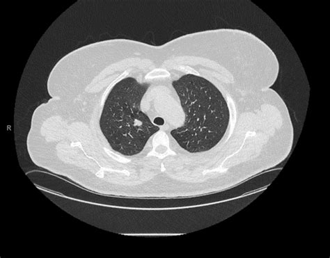 Video Atlas Of Pulmonary Segmentectomy Robotic Assisted Right S1 Segmentectomy With 3