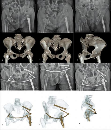 A New Technique For Percutaneous Screw Fixation For Treating Ffp Iiia And Iiib Fragility