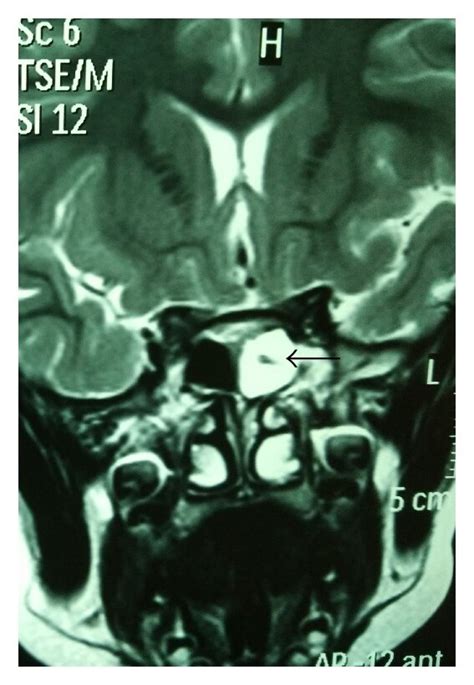 A And B Axial Ct Scans Showing Only Sphenoid Sinus With Soft Tissue