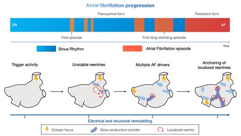 Precision Medicine To Control Atrial Fibrillation Progression