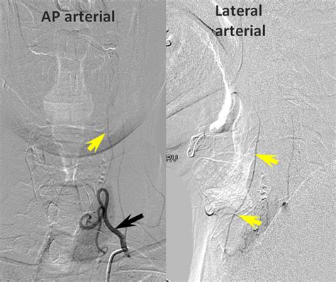 Thyroid Arteries