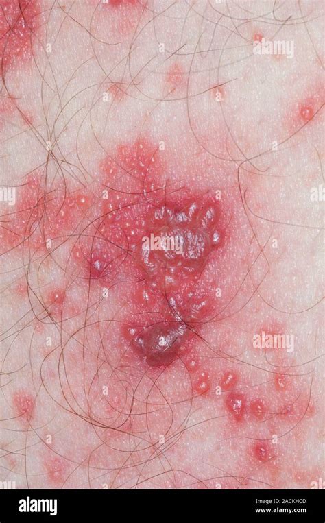 Close Up Of A Shingles Rash Of Blisters On The Skin Of The Leg In An 85 Year Old Male Patient
