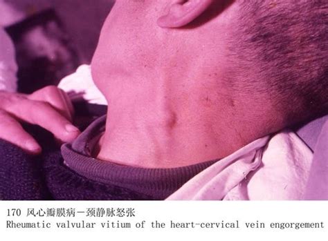 颈静脉怒张图片 图库 五毛网