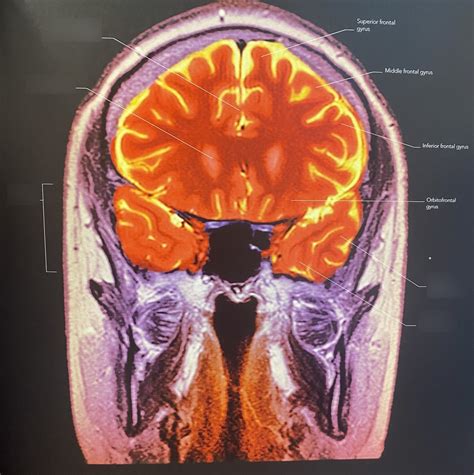 Mri The Temporal Lobes Diagram Quizlet