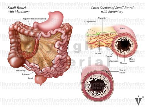 Stock Bowel Anomalies Obstructions Injuries — Illustrated Verdict