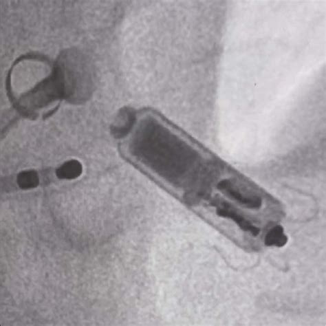 Pdf Leadless Pacemakers A Contemporary Review