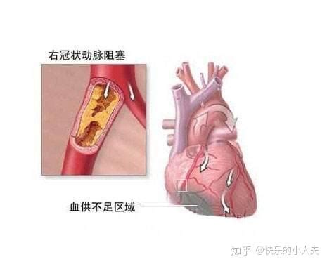 出现这6个症状可能是心肌缺血了医生提醒做2项检查就能确诊 知乎