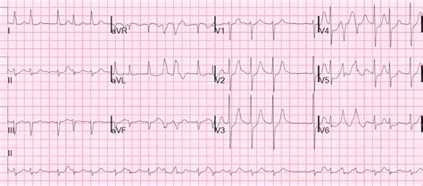 Afib With Rvr A Fib With Rvr Meaning Hhct