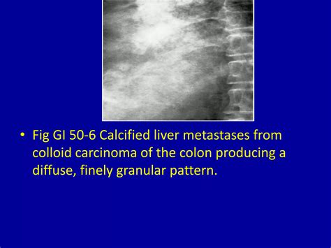50 Liver Calcification Pptx