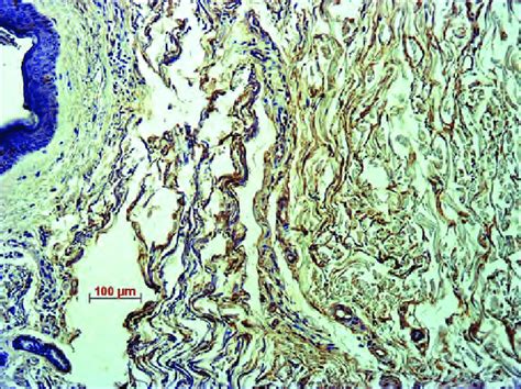 Positive Fibronectin In The Extracellular Matrix In The Superficial