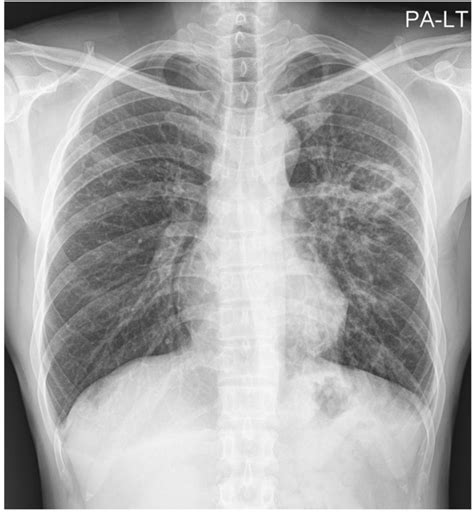 활동성 폐결핵 폐엑스레이 사진 증례 Micronodule 네이버 블로그