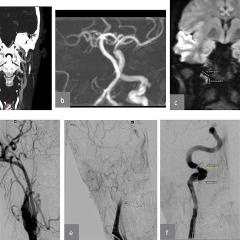 A Case With Dsa Cta Mra And Dwi That Shows That Cta And Mra Were Download Scientific Diagram