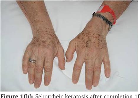 Figure 1 From Oral Acanthosis Nigricans An And Leser Trelat Sign